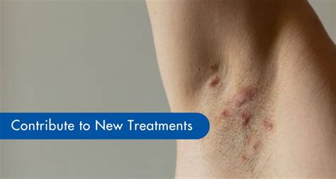 Improving Care For Hidradenitis Suppurativa Sinclair Dermatology