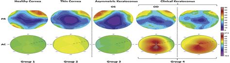 Mapping Of Corneal Birefringence In Thin And Asymmetric Kera