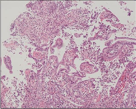 Fibrinous Exudate Fibrinous Exudate