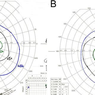 Results Of Goldmann Visual Field Testing Of Right A And Left B Eyes Download Scientific