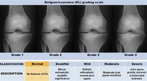 TradeMed Industry News AI Could Help Radiologists Improve Osteoarthritis X Ray Diagnosis