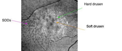 Case 65 Subretinal Drusenoid Deposits Sdds In Amd Page 11 Of 66