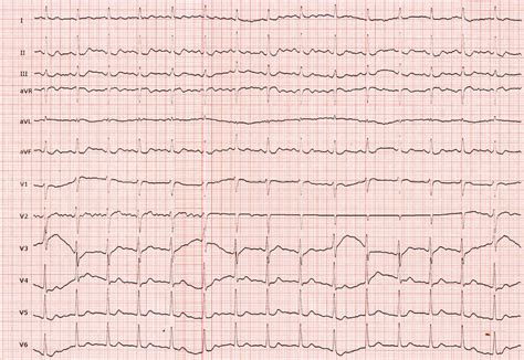 Surgical Milestone Philadelphias First Micra Av Pacemaker Implanted