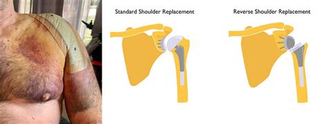 My Search For The Best Treatment Option When My Shoulders Went South