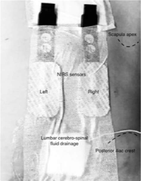 Nirs Sensors Placement Nirs Near Infra Red Spectroscopy Download