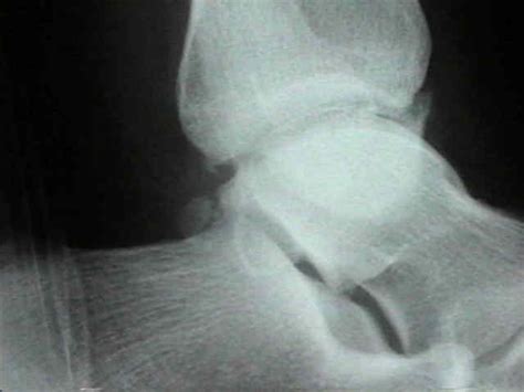 Fractures Of Posterior Process Of Talus Wheeless Textbook Of