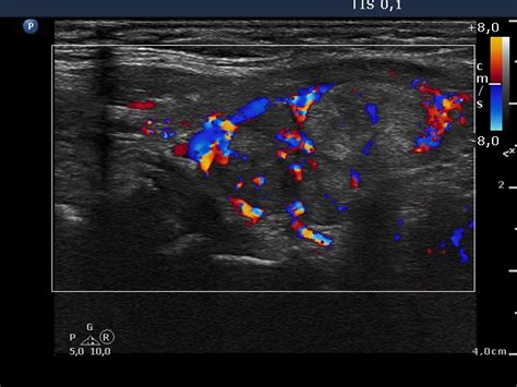 The Echogenicity Of The Nodule