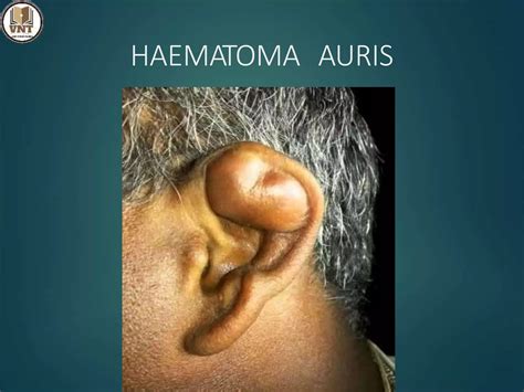 Diseases Of External Ear Ppt