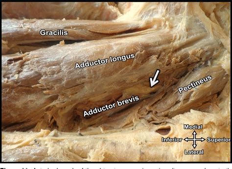 Adductor Longus Cadaver
