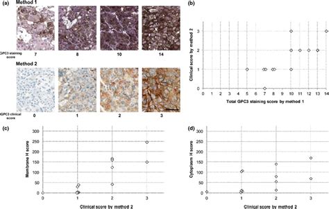 Immunohistochemistry Ihc Of Glypican 3 Gpc3 In Hepatocellular