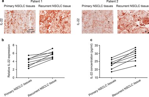 IL 22 Is Overexpressed In Recurrent NSCLC Tissue And Serum Samples A