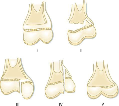 Musculoskeletal Injuries Anesthesia Key