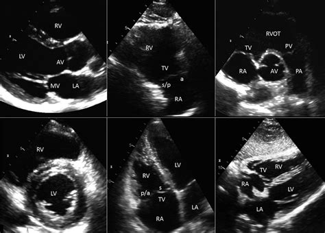 Recommended Echocardiographic Views For The Assessment Of The Right