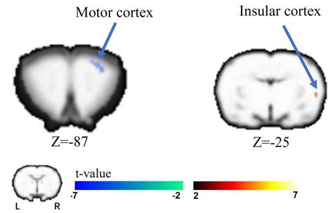 Resting State Brain Network Remodeling After Different Nerve
