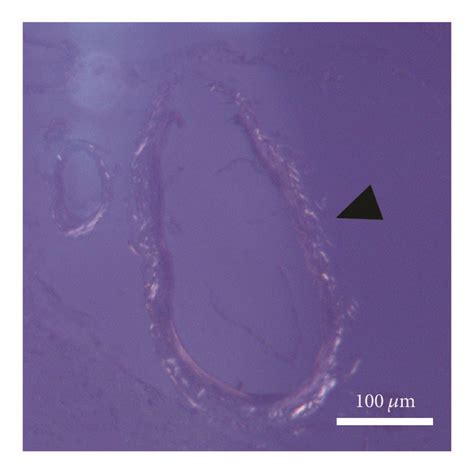 Cerebral Amyloid Angiopathy Represented By Congo Red Staining 100x