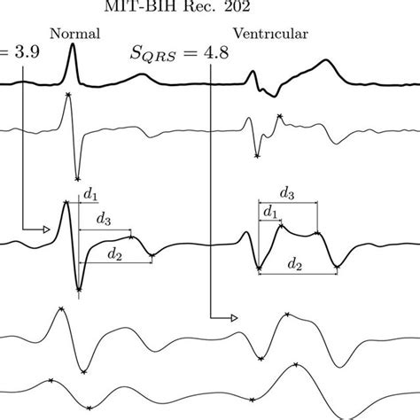 Illustration Of The Features Calculated From The Vcg Loop Computed With Download Scientific