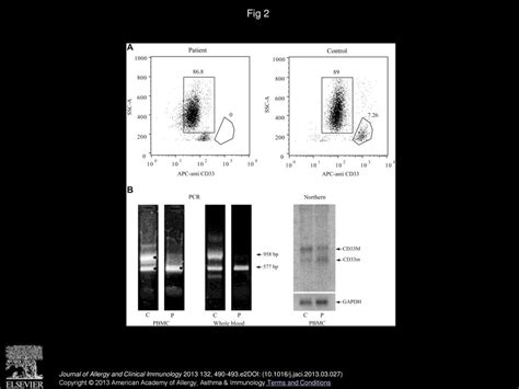 Splicing Defect Of Cd33 And Inflammatory Syndrome Associated With