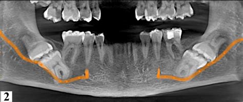 Reformatted Panoramic At 14 Mm Slice Thickness Showing The Course Of