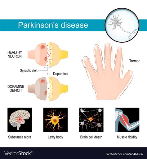 Parkinsons Disease Joint Pain At Jose Derringer Blog