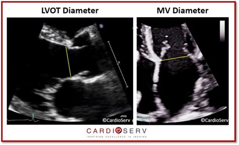 3 Steps To Quantifying Mr Via Stroke Volume Method Cardioserv