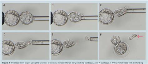 Trophectoderm Biopsy Using The Pulling Technique Indicated For An Download Scientific
