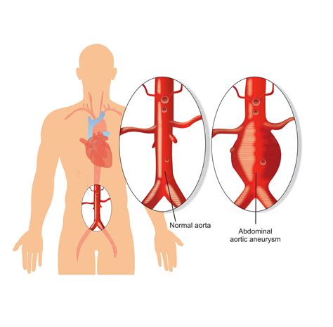 Artery Conditions Treated By Our Vascular Specialists Big Island Hi