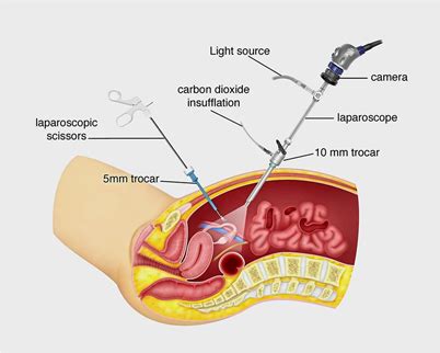 Laparoscopy Dr Nitu Bajekal