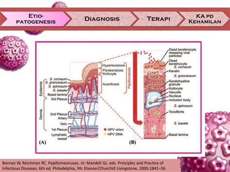 Presentation Kondiloma Akuminata Pdf