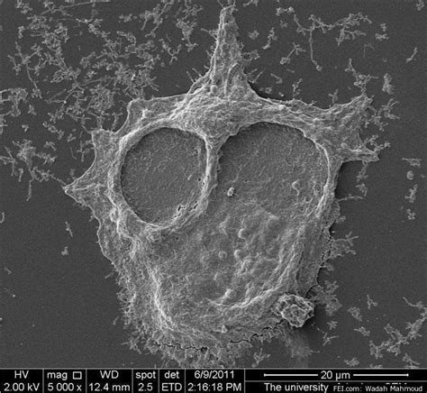 Breast Cancer Cell Examined Up Close Under An Electron Microscope