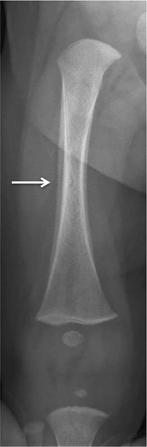 Congenital Syphilis Xray