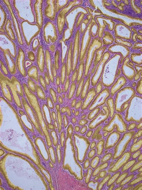 Adenoma Of Colon Light Micrograph Stock Image C021 6172 Science Photo Library