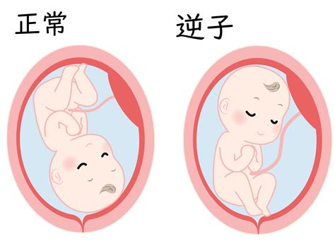 逆子治療 みなと整骨院