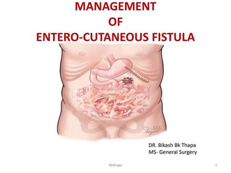 Enterocutaneous Fistulas Ppt