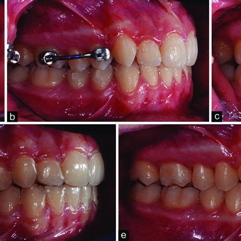 Moderate Sagittal Correction A Initial Photographs Show A Molar