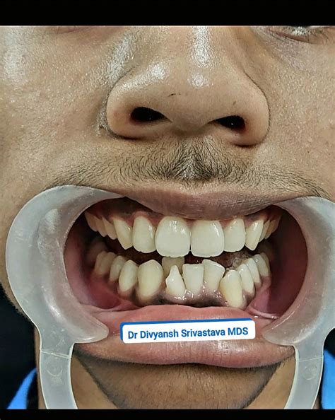 Dr Divyansh Srivastava On Linkedin Orthodontic Correction Of Anterior Crowding