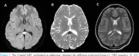 Figure 1 From Reversible Splenial Lesion Syndrome Developing In The