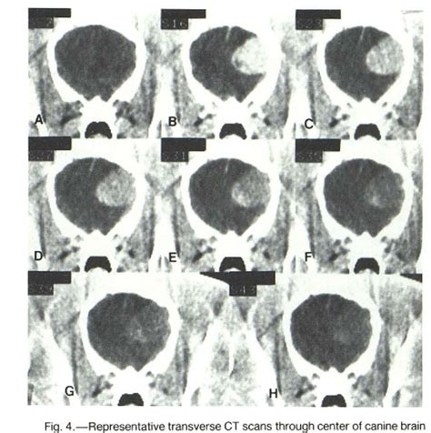 Figure 4 From Contrast Media In Ct Of Brain Tumors Relative Uptake Of Low And High Osmolality