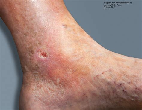 Venous Ulcer Treatment Exploring Treatments For Venous Leg Ulcers