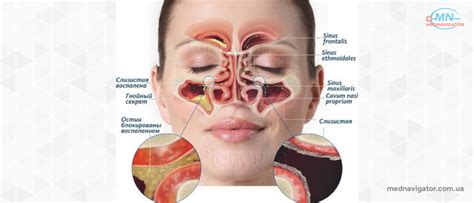 Воспаление слизистой оболочки носа Mednavigator