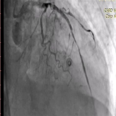 Left Ventricle Apical Thrombus Download Scientific Diagram