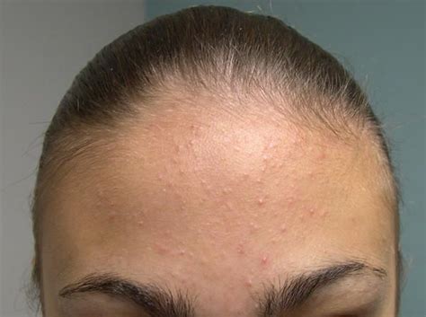 Why Do I Have Little Bumps On My Forehead