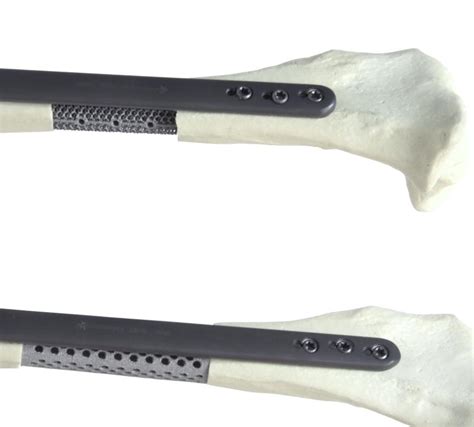 Biosurgex On Linkedin Do Our Porous Titanium Segmental Implants Work In The Reconstruction Of…