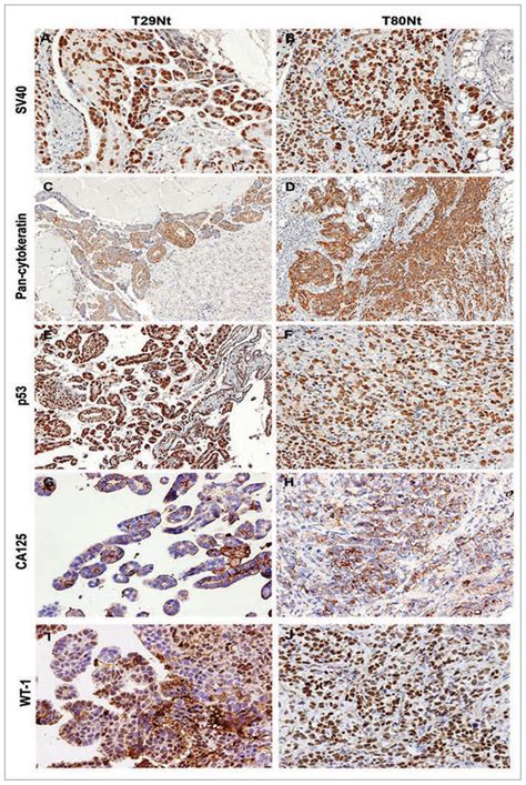 Immunohistochemical Analyses Of Tumors Immunohistochemical Staining