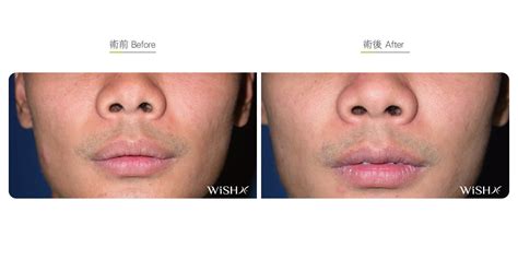 Lip Reduction Sexy Lip Surgery Lip Plasty Wishclinic