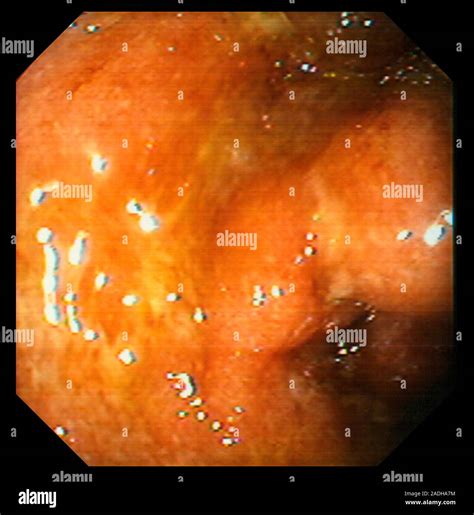 Ulcerative Colitis Endoscope View Showing A Colon Large Intestine