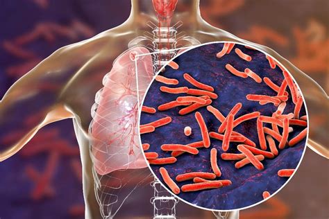 Mycobacterium Tuberculosis Qué Es Características Morfología Cultivo