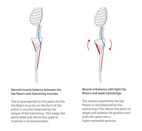 Hamstring Bridge Tract Gray Chiropractic St Catharines Spine And Joint Clinic