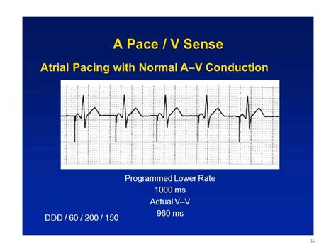 Evaluation And Management Of Pacemaker Malfunction Pptx