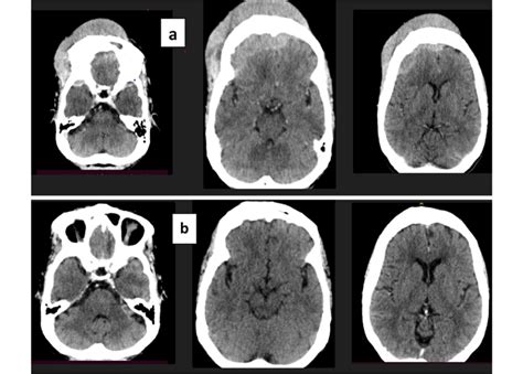 A And B Cranial Ct Scan Before And After The Disappearance Of Tumour
