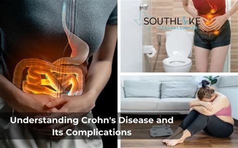 Crohns Disease And Fistula Care Expert Advice Southlake General Surgery